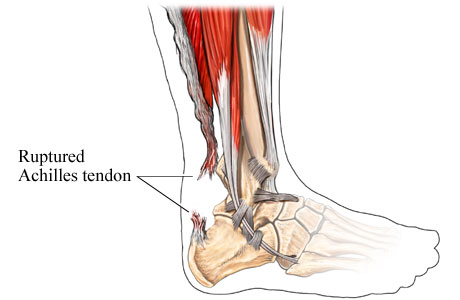 Ruptured achilles tendon Ruptured achilles tendon BOOST PHYSIO