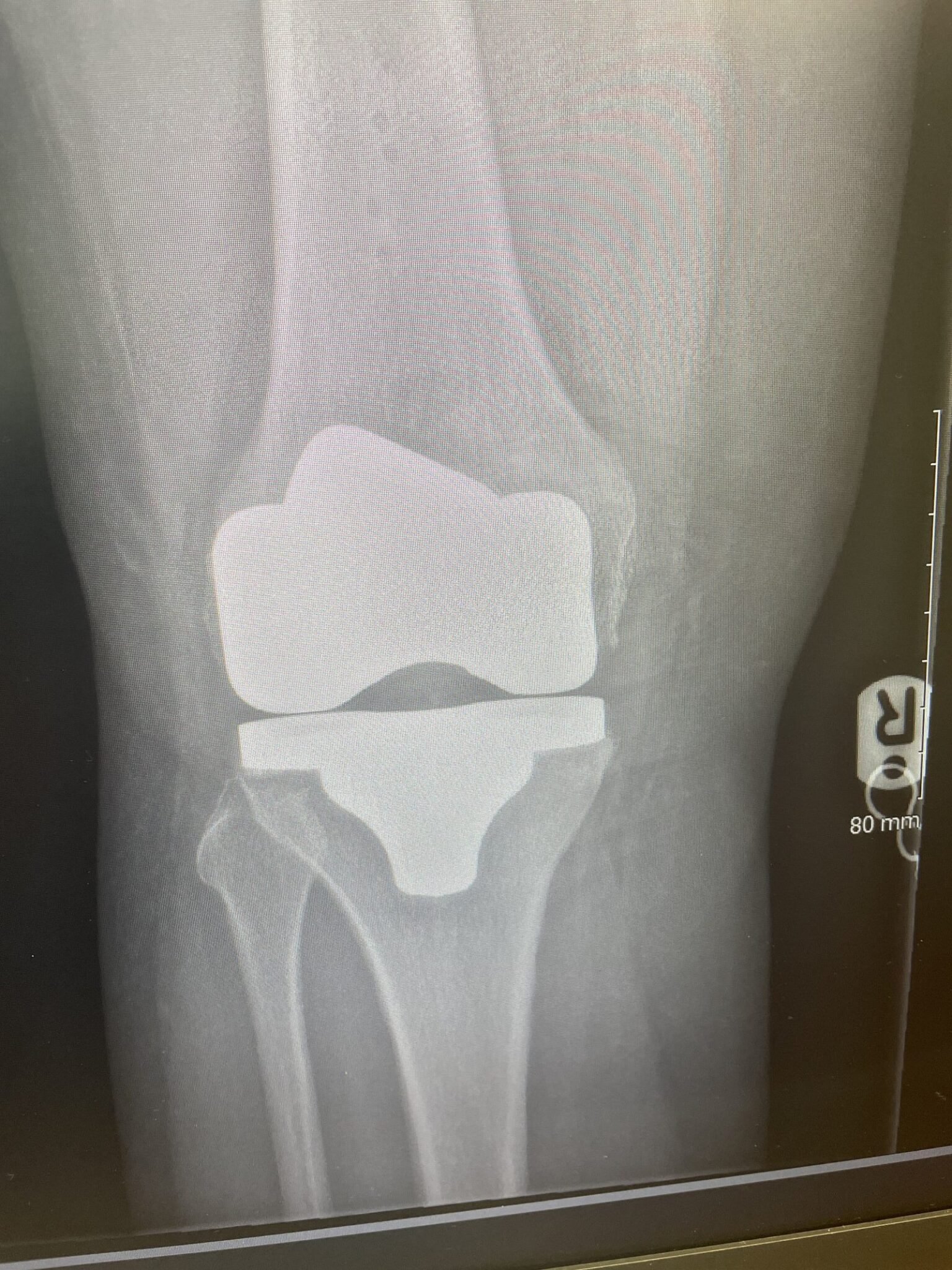 Total Knee Replacement Physiotherapy Post Op - Boost Physio